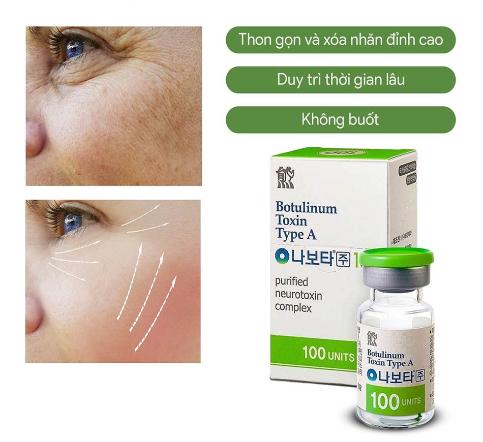 Botox 100 Units Botulinum Toxin Type A Nabota giúp xóa nhăn da