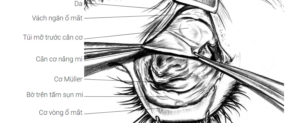 Đặc điểm giải phẫu mi mắt và những ứng dụng trong phẫu thuật mắt