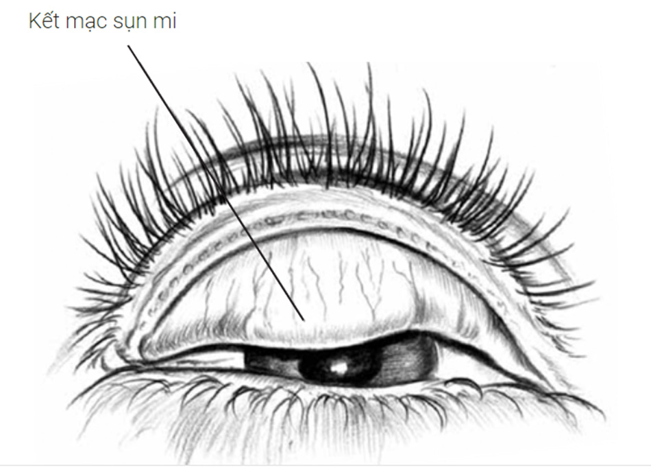 Quy trình phẫu thuật và một số loại phẫu thuật sụp mí mắt