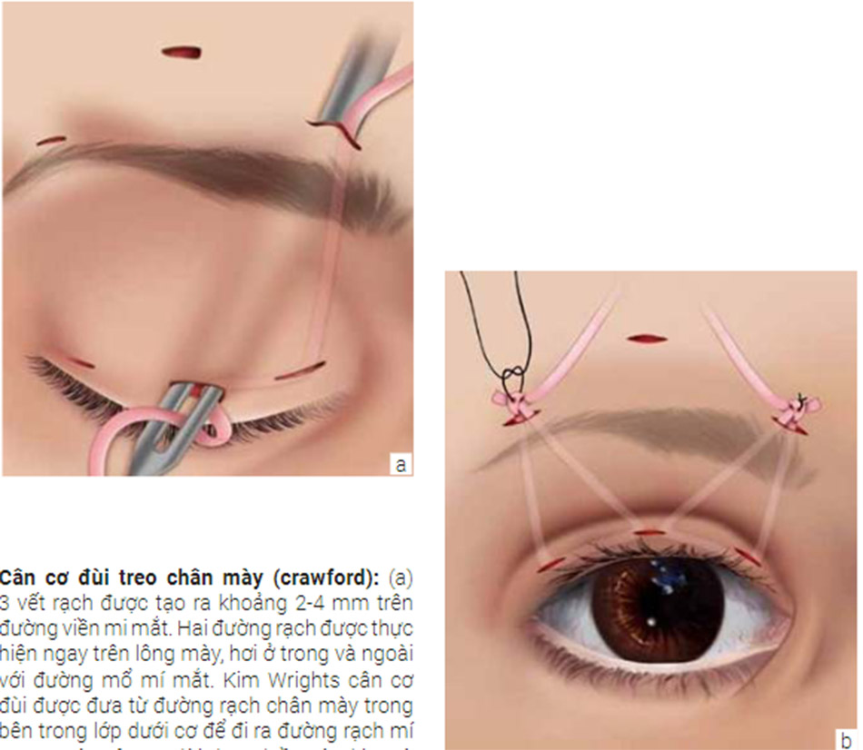 Quy trình phẫu thuật và một số loại phẫu thuật sụp mí mắt