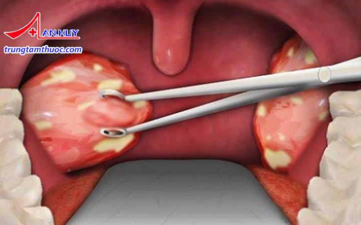 Ung thư amidan khẩu cái: Nguyên nhân, triệu chứng, điều trị