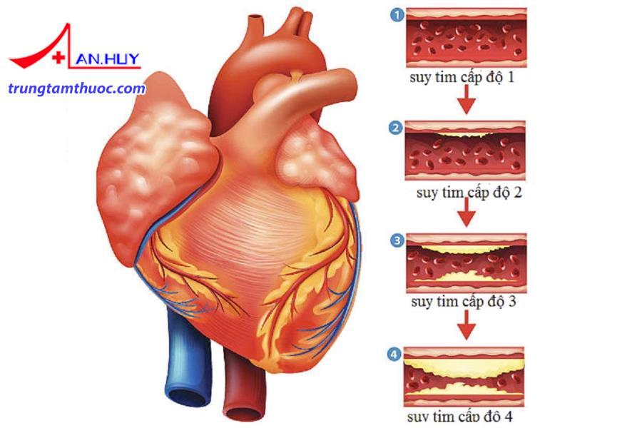 CHẨN ĐOÁN VÀ HƯỚNG DẪN ĐIỀU TRỊ BỆNH SUY TIM MẠN TÍNH
